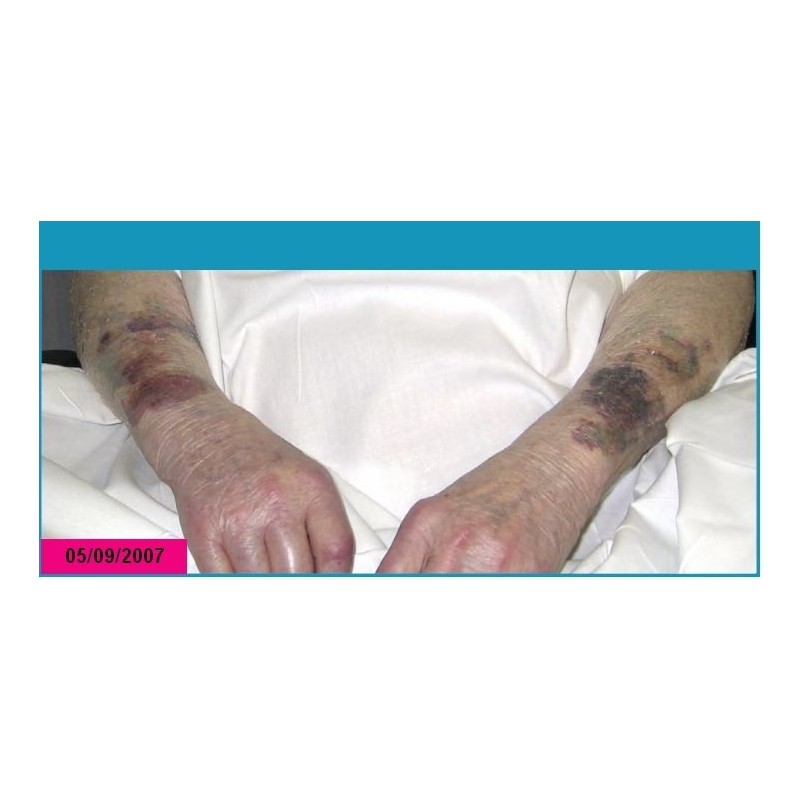 Protège avant-bras | Teamalex Matériel Médical